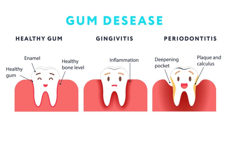 What Is Gingivitis? - Plotting with Dr. Potts